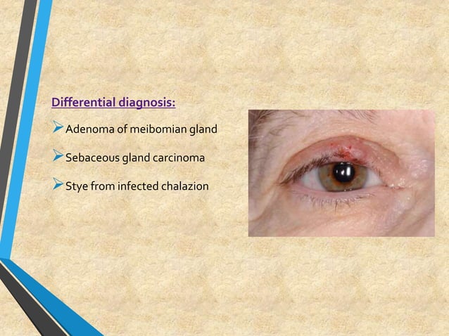 Chalazion | PPTX