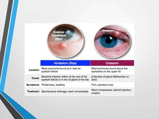 Chalazion | PPTX