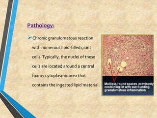 Chalazion Histology