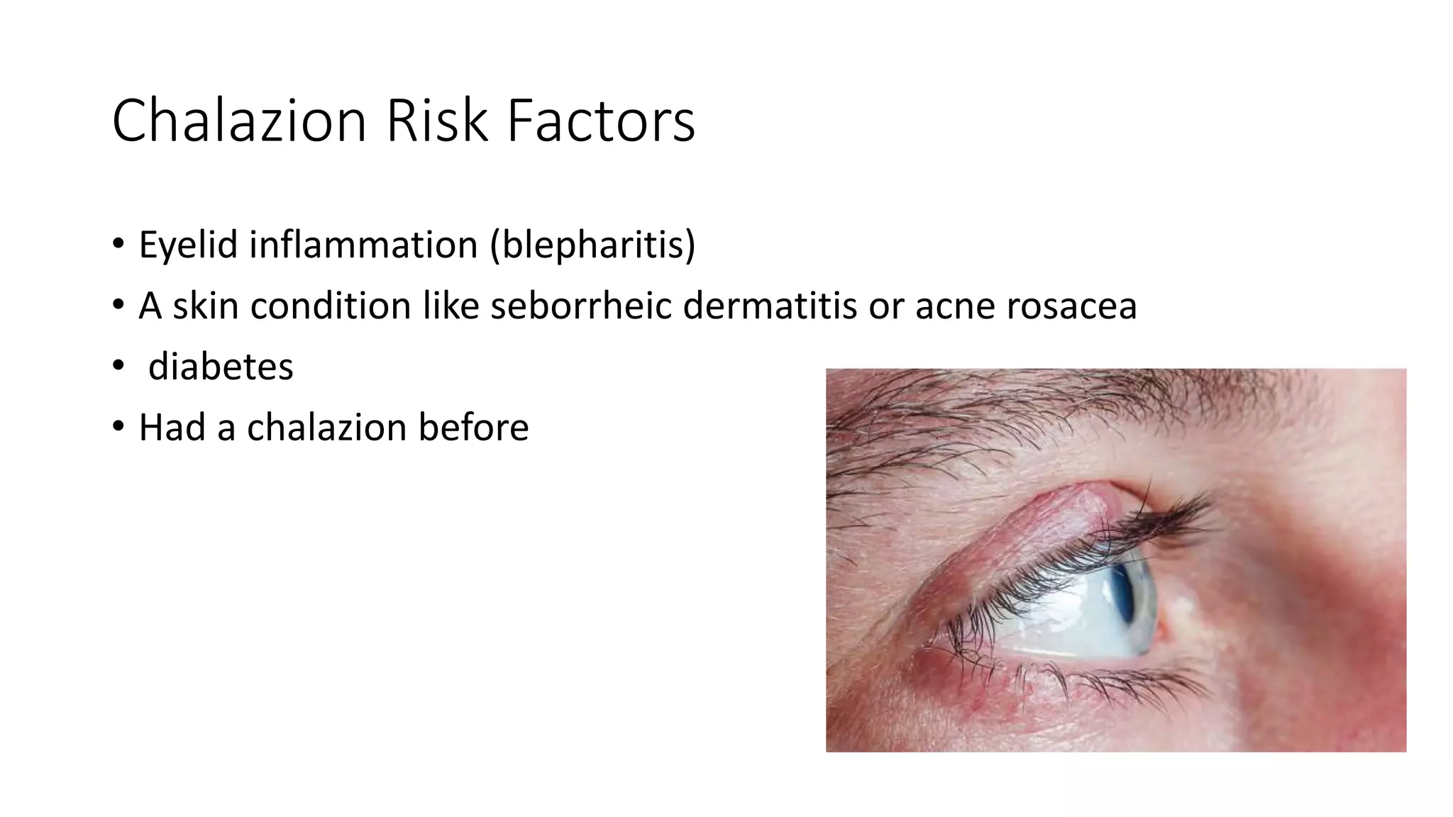CHALAZION.pptx