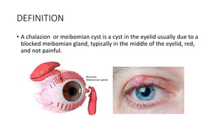 CHALAZION.pptx