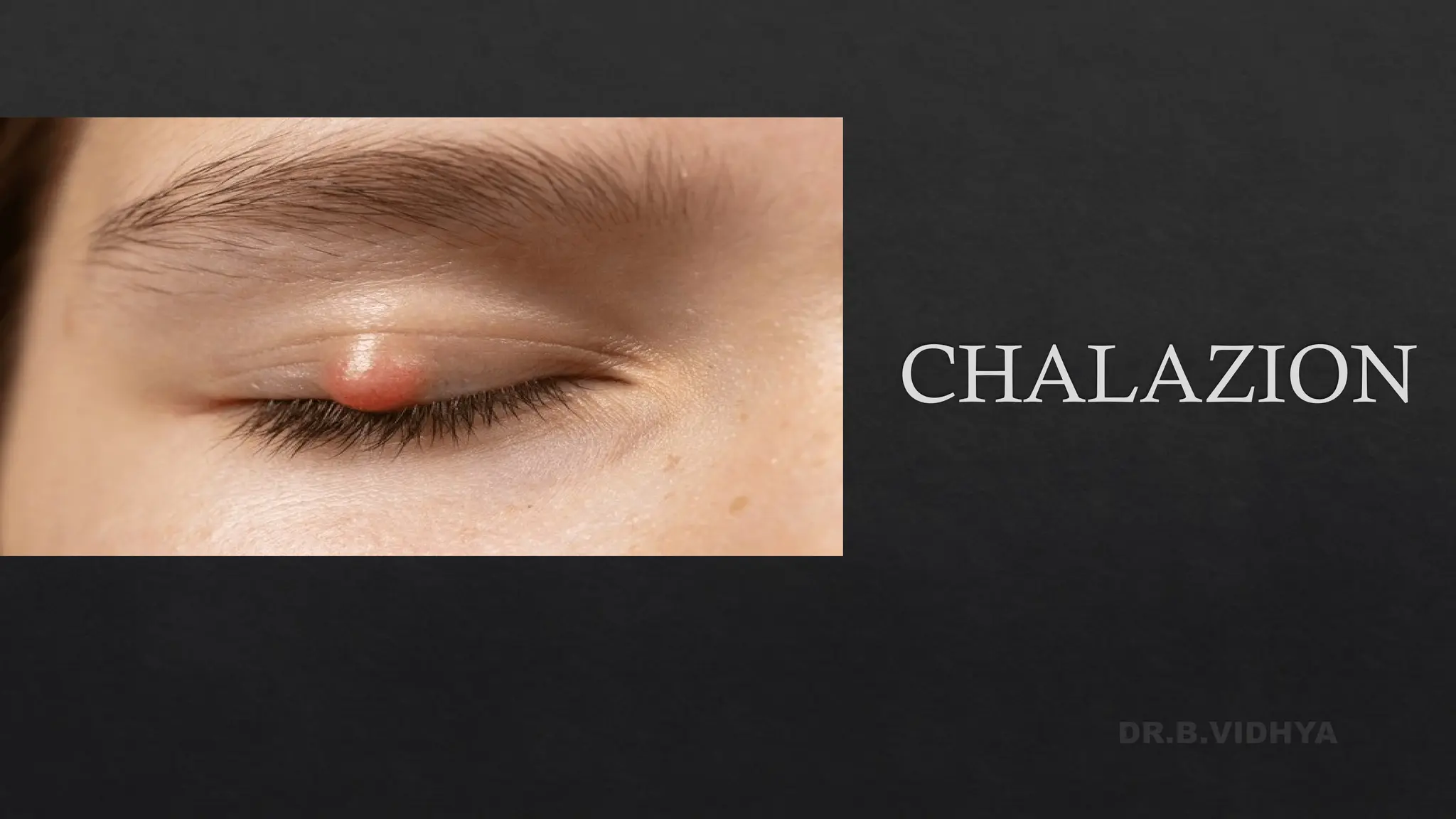 chalazion of the eye power point pre.pptx