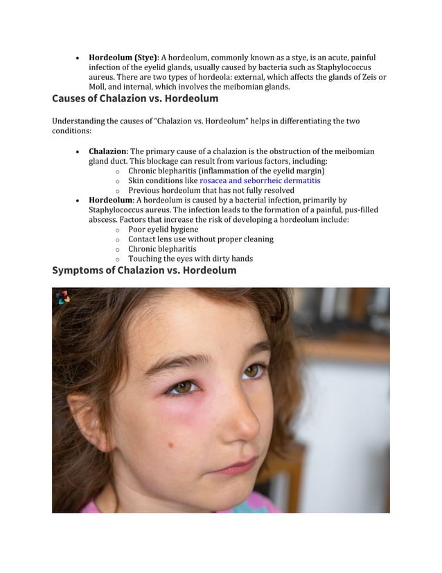 Chalazion vs. Hordeolum: Differences, Causes, Symptoms, and Treatment ...