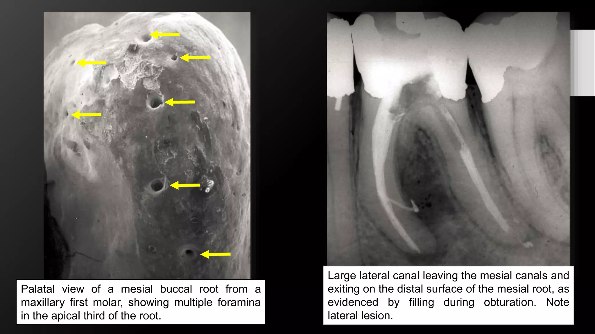 Challenges in working length determination | PPTX
