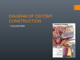 Challenging ostomies | PPT | Digestive Disorders | Diseases and Conditions
