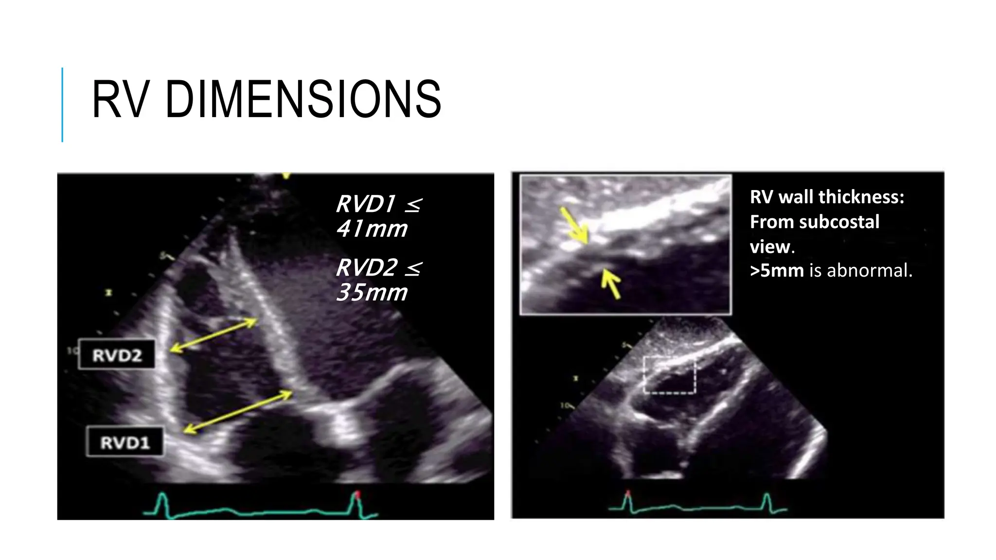 Chamber quantification by echo for ER and IM.pptx