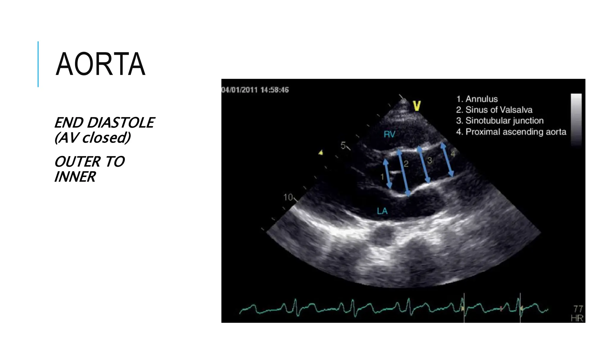 Chamber quantification by echo for ER and IM.pptx