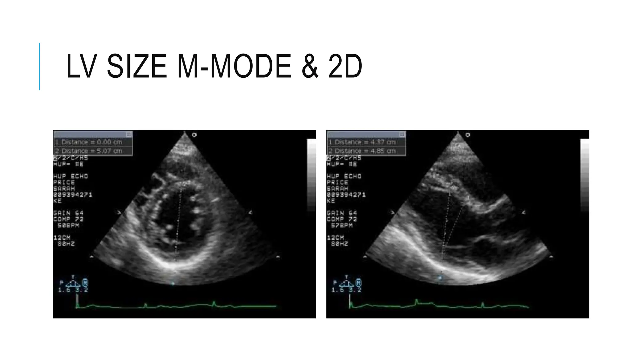 Chamber quantification by echo for ER and IM.pptx
