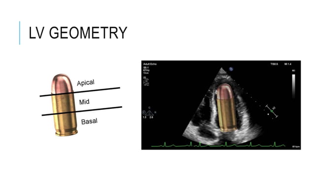 Chamber quantification by echo for ER and IM.pptx