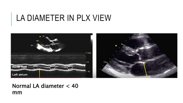 Chamber quantification by echo for ER and IM.pptx