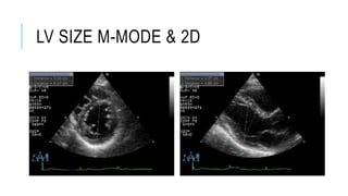 Chamber quantification by echo for ER and IM.pptx