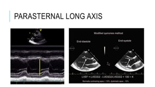 Chamber quantification by echo for ER and IM.pptx