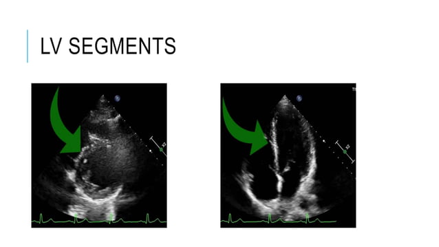 Chamber quantification by echo for ER and IM.pptx