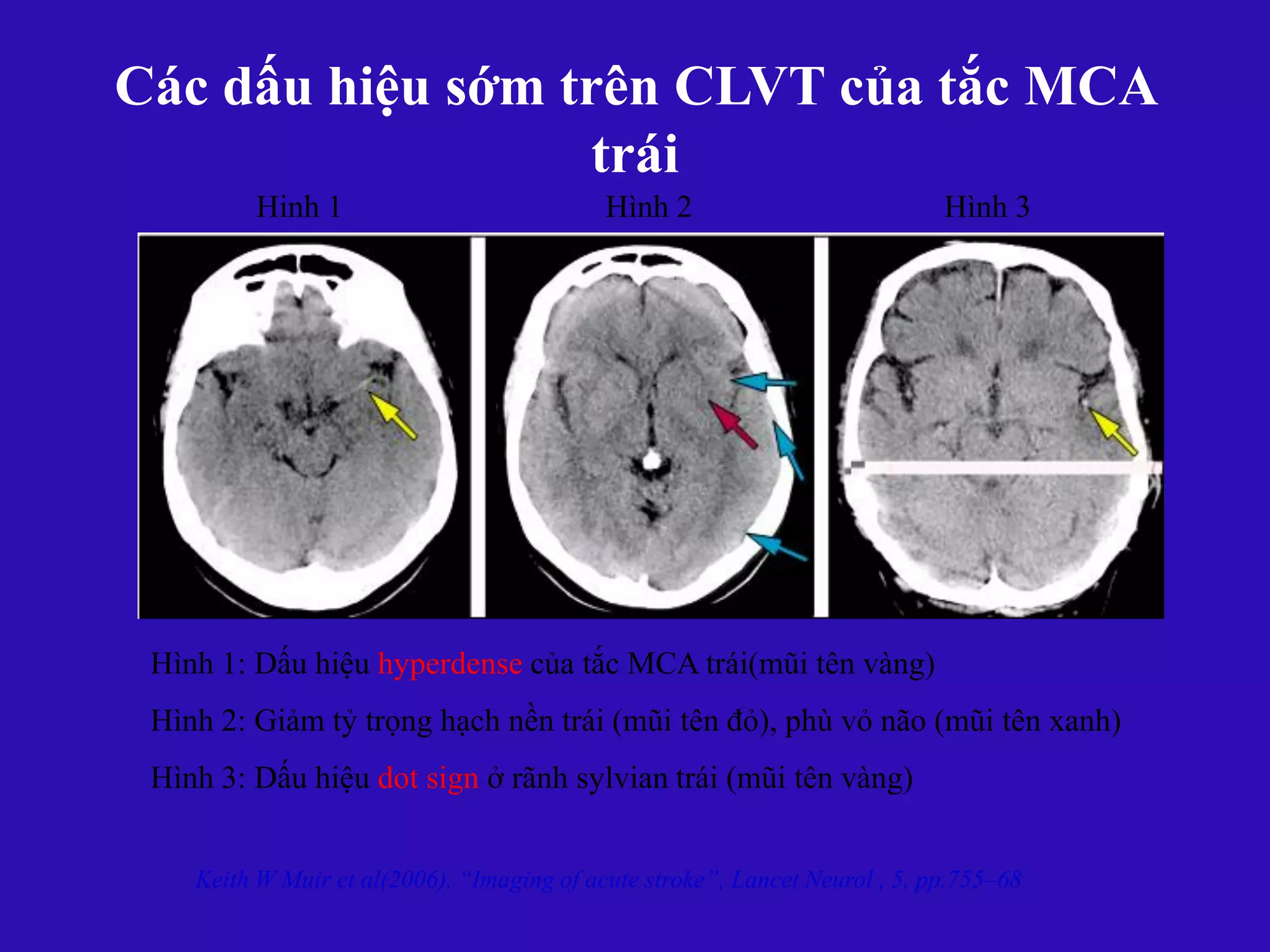 CHẨN ĐOÁN VÀ ĐIỀU TRỊ ĐỘT QUỴ NÃO | PDF