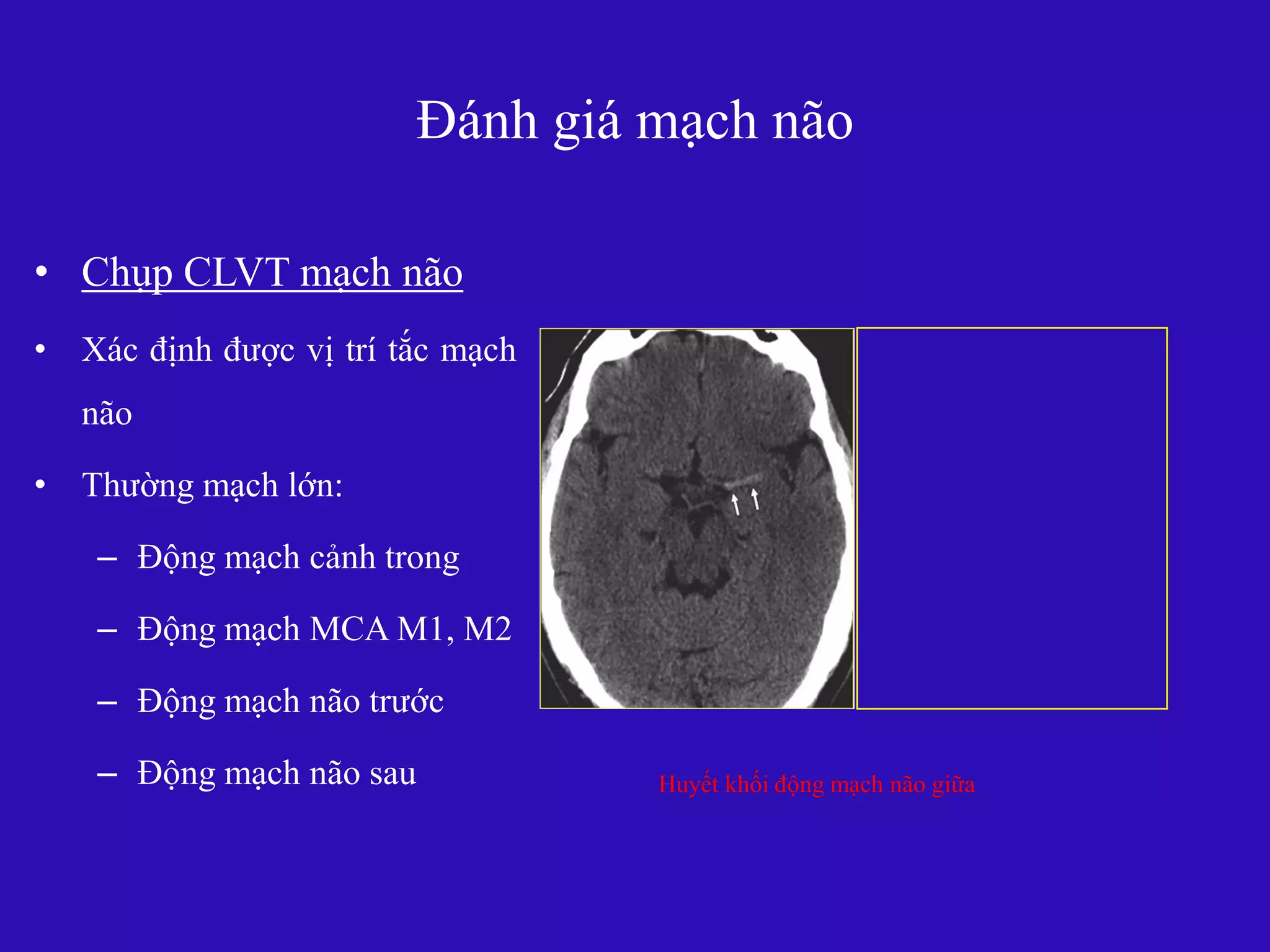 CHẨN ĐOÁN VÀ ĐIỀU TRỊ ĐỘT QUỴ NÃO | PDF