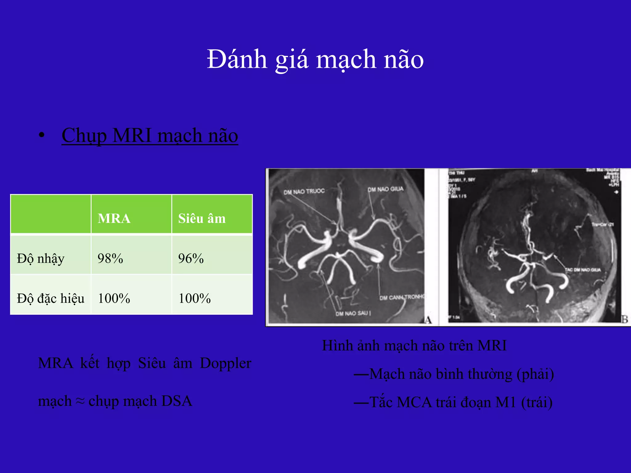 CHẨN ĐOÁN VÀ ĐIỀU TRỊ ĐỘT QUỴ NÃO | PDF