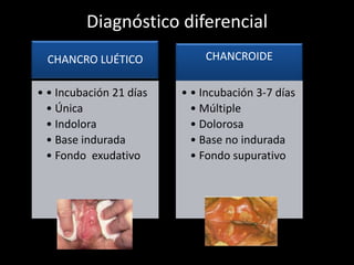 Chancro | PPTX
