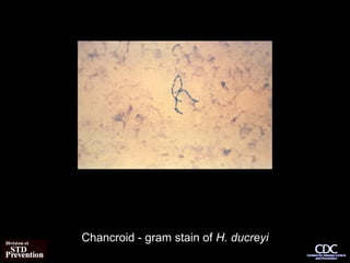 Chancroid | PPT