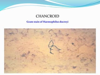 UPADAMSHA (Chancroid / SOFT CHANCRE) | PPSX