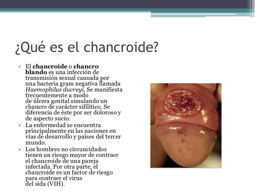 Chancroide