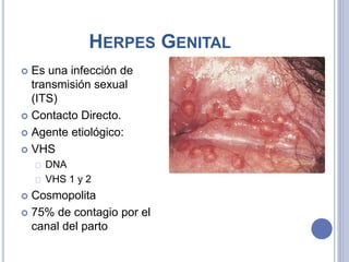 Chancroide, Chlamydia y Herpes | PPTX