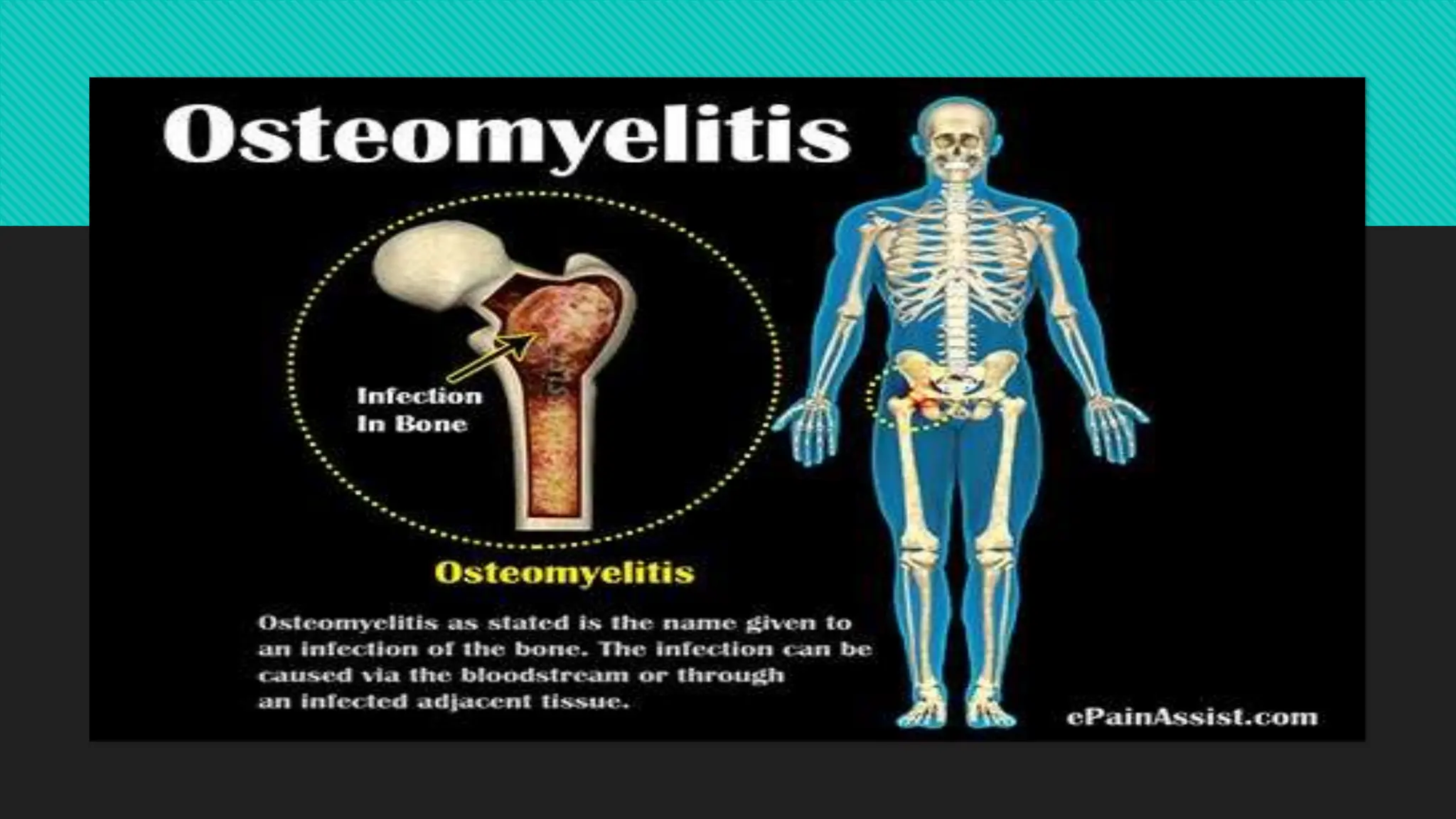 Chandana - Osteomyelitis .omfs surgery bds | PPTX