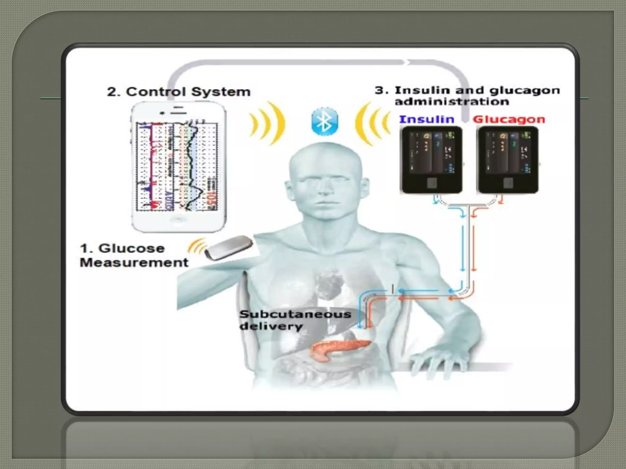 Chandru bionic pancreasss | PPT | Free Download