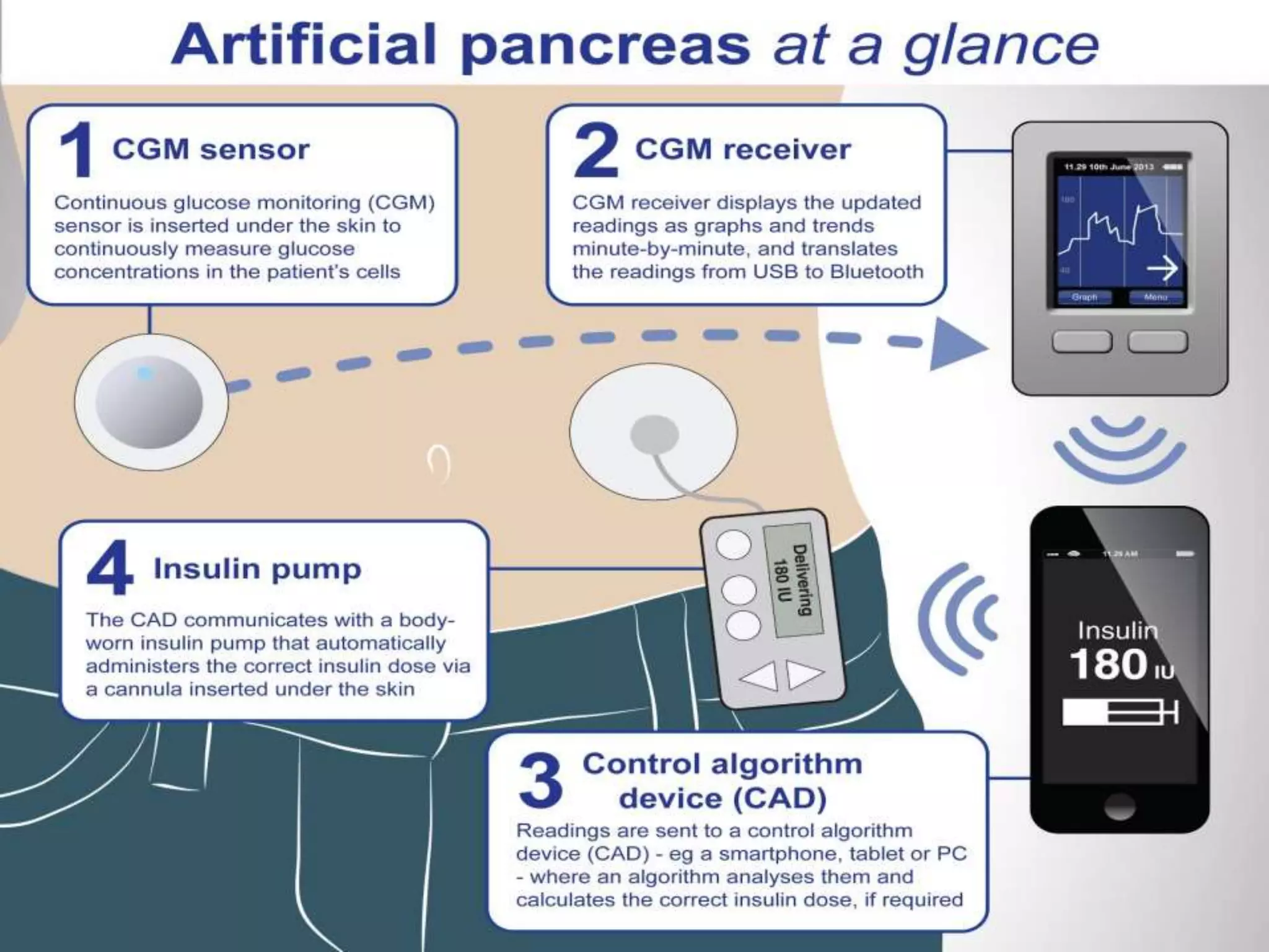 Chandru bionic pancreasss | PPT | Free Download
