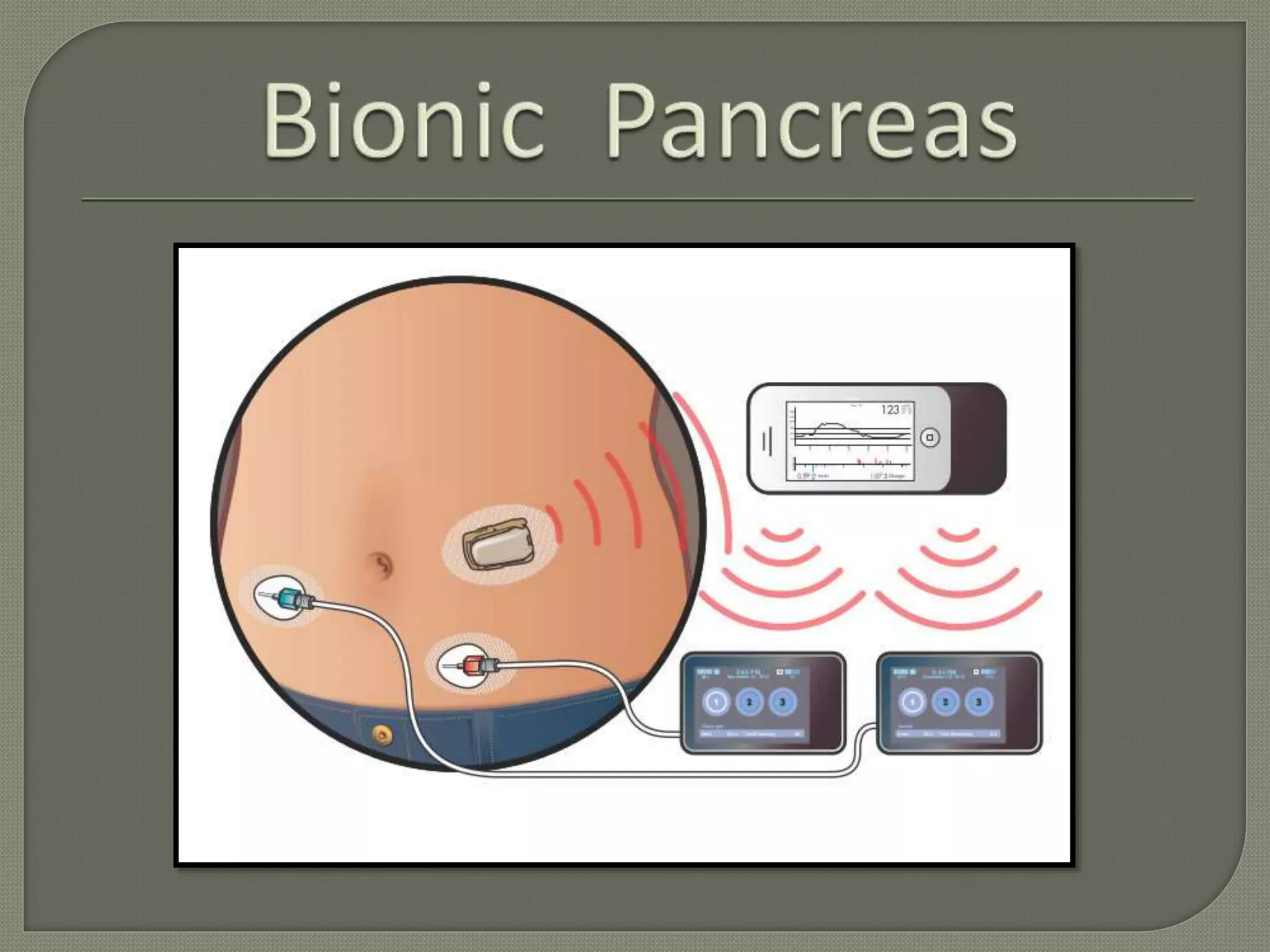 Chandru bionic pancreasss | PPT | Free Download