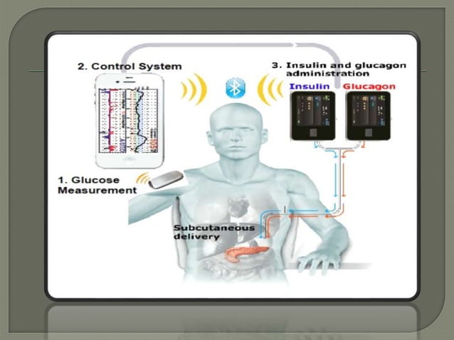 Chandru bionic pancreasss | PPT