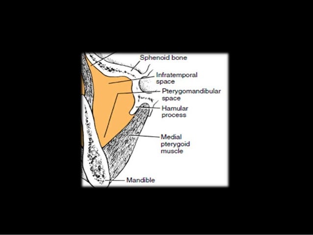 Pterygomandibular Space Infection Complications Of Severe Odontogenic