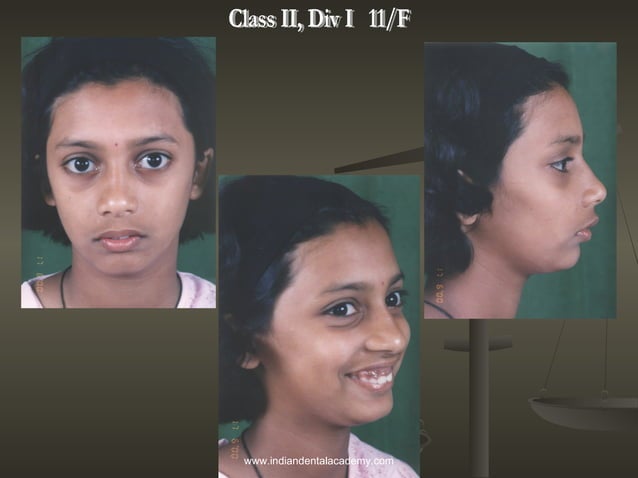 Changing trends in preadjusted edgewise system /certified fixed ...