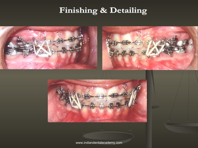 Changing trends in preadjusted edgewise system /certified fixed ...