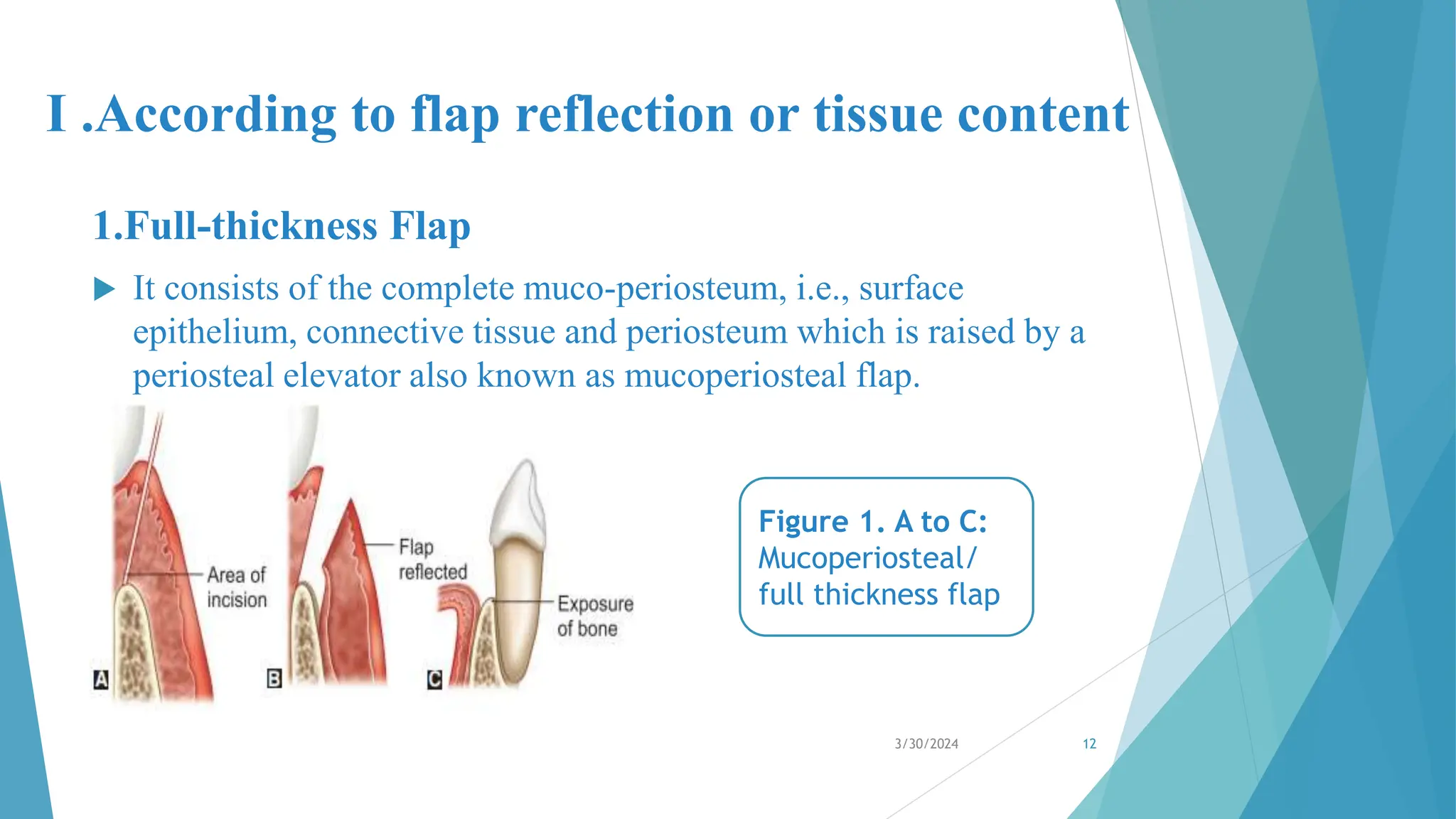CHAN JOHN PERIO.pptx periodontal flap ppt | PPTX