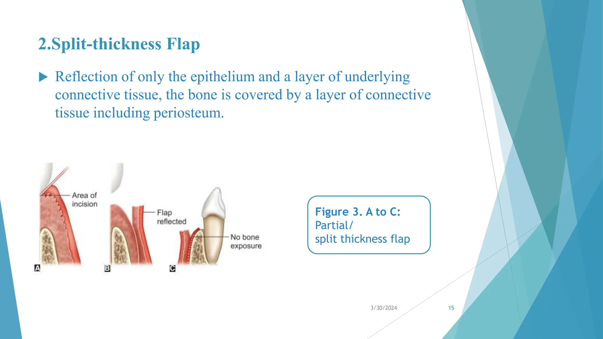 CHAN JOHN PERIO.pptx periodontal flap ppt | PPTX