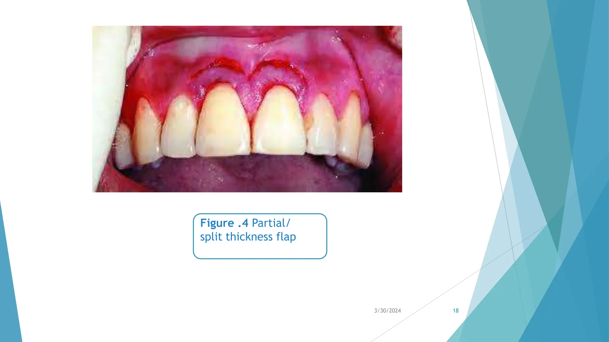 CHAN JOHN PERIO.pptx periodontal flap ppt | PPTX