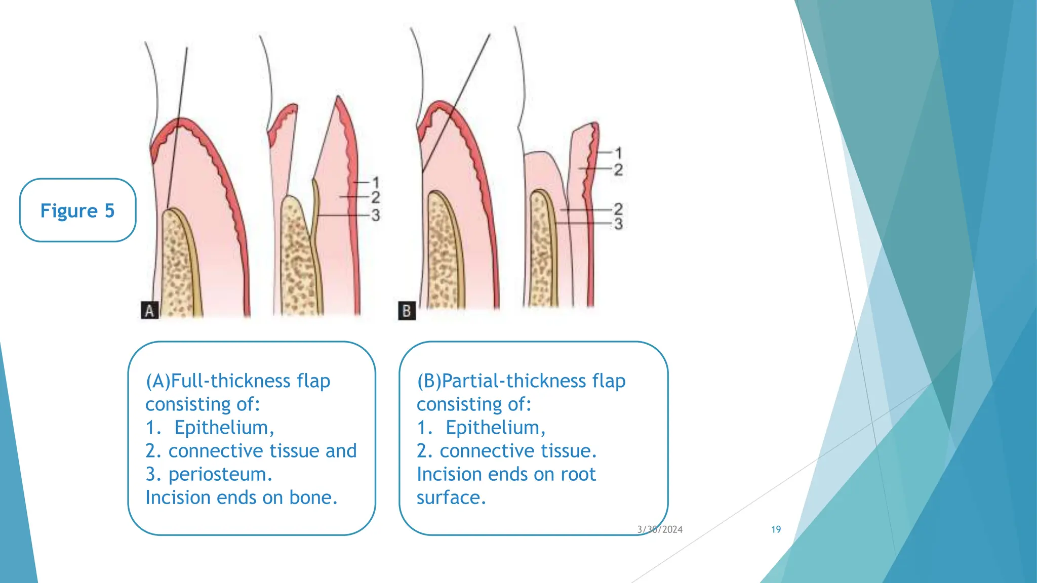 CHAN JOHN PERIO.pptx periodontal flap ppt | PPTX