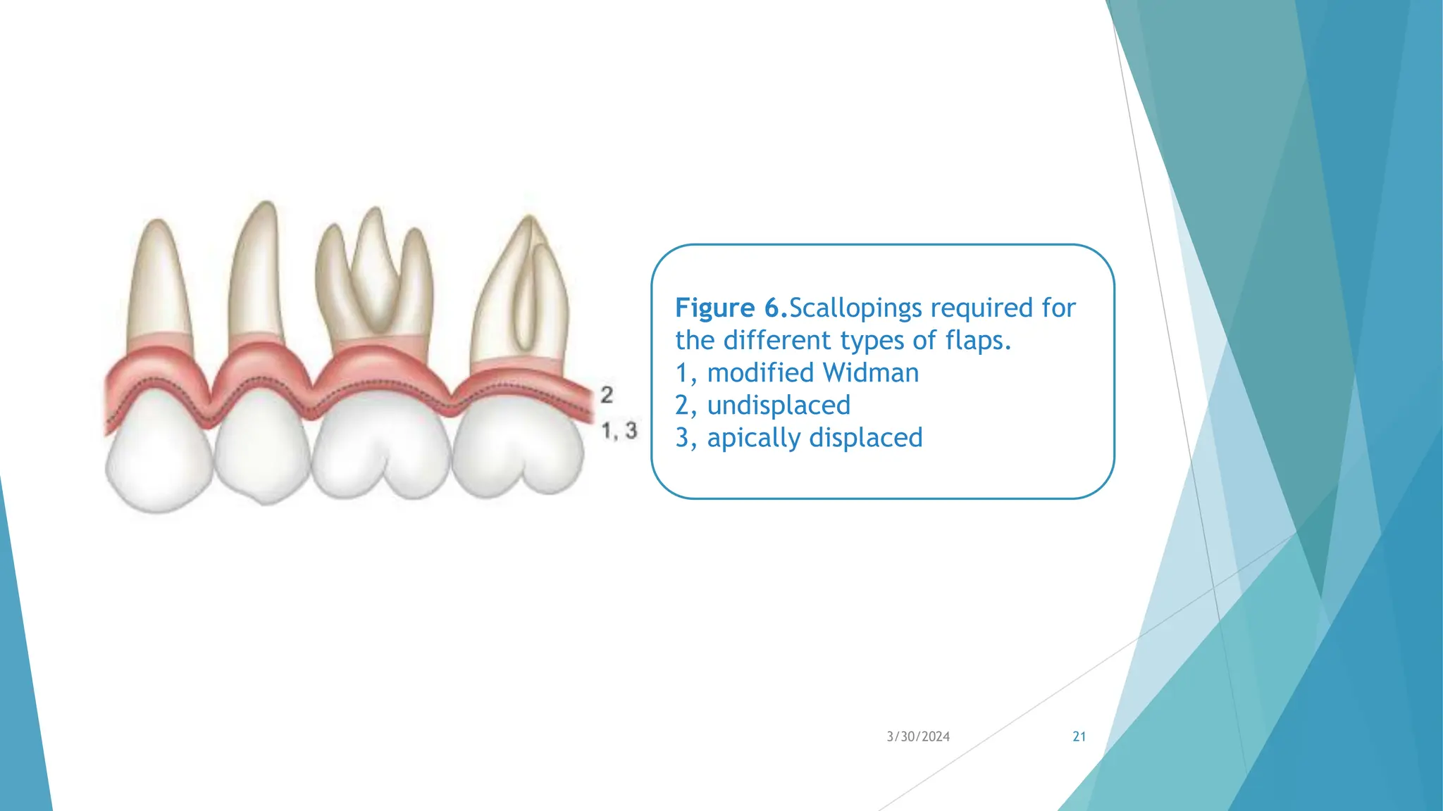 CHAN JOHN PERIO.pptx periodontal flap ppt | PPTX