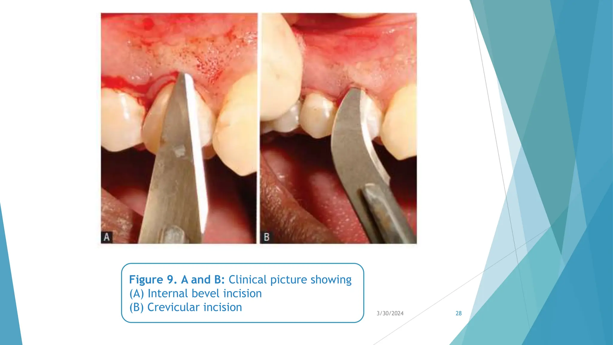 CHAN JOHN PERIO.pptx periodontal flap ppt | PPTX
