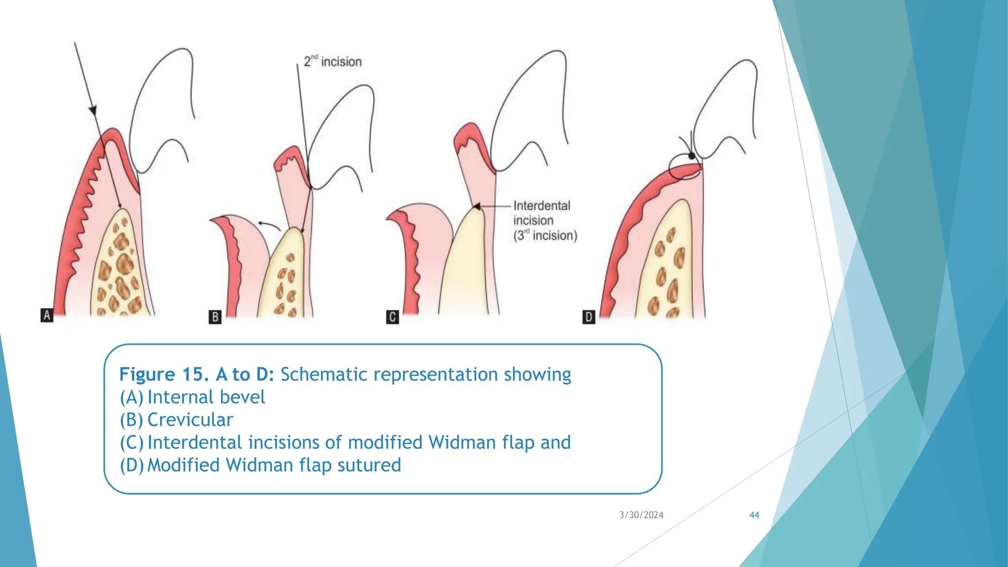 CHAN JOHN PERIO.pptx periodontal flap ppt | PPTX