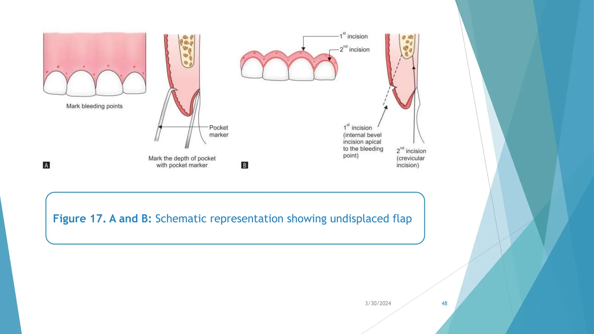CHAN JOHN PERIO.pptx periodontal flap ppt | PPTX
