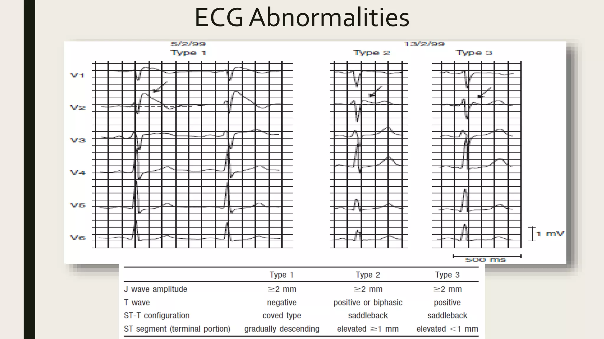 Cardiac Channelopathies | PPTX