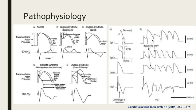 Cardiac Channelopathies | PPT