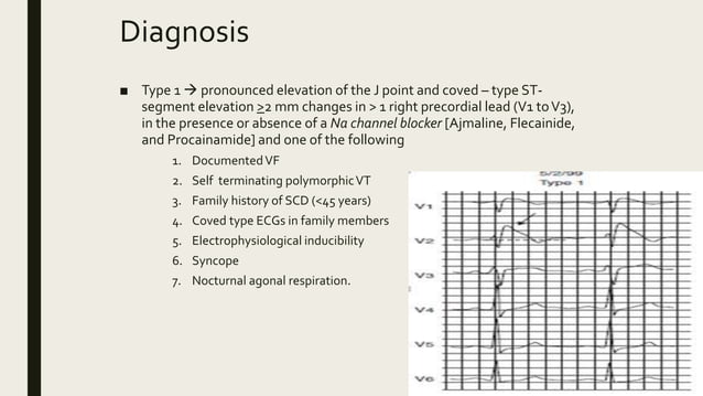 Cardiac Channelopathies | PPT