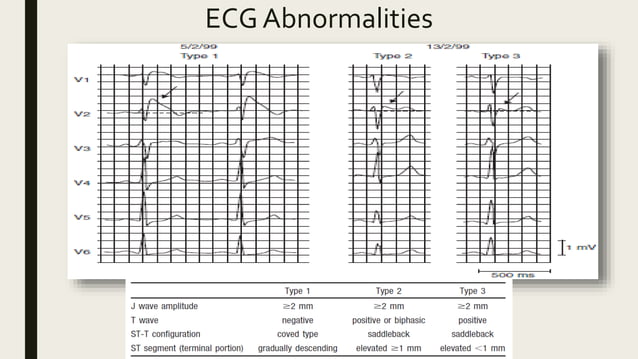 Cardiac Channelopathies | PPT