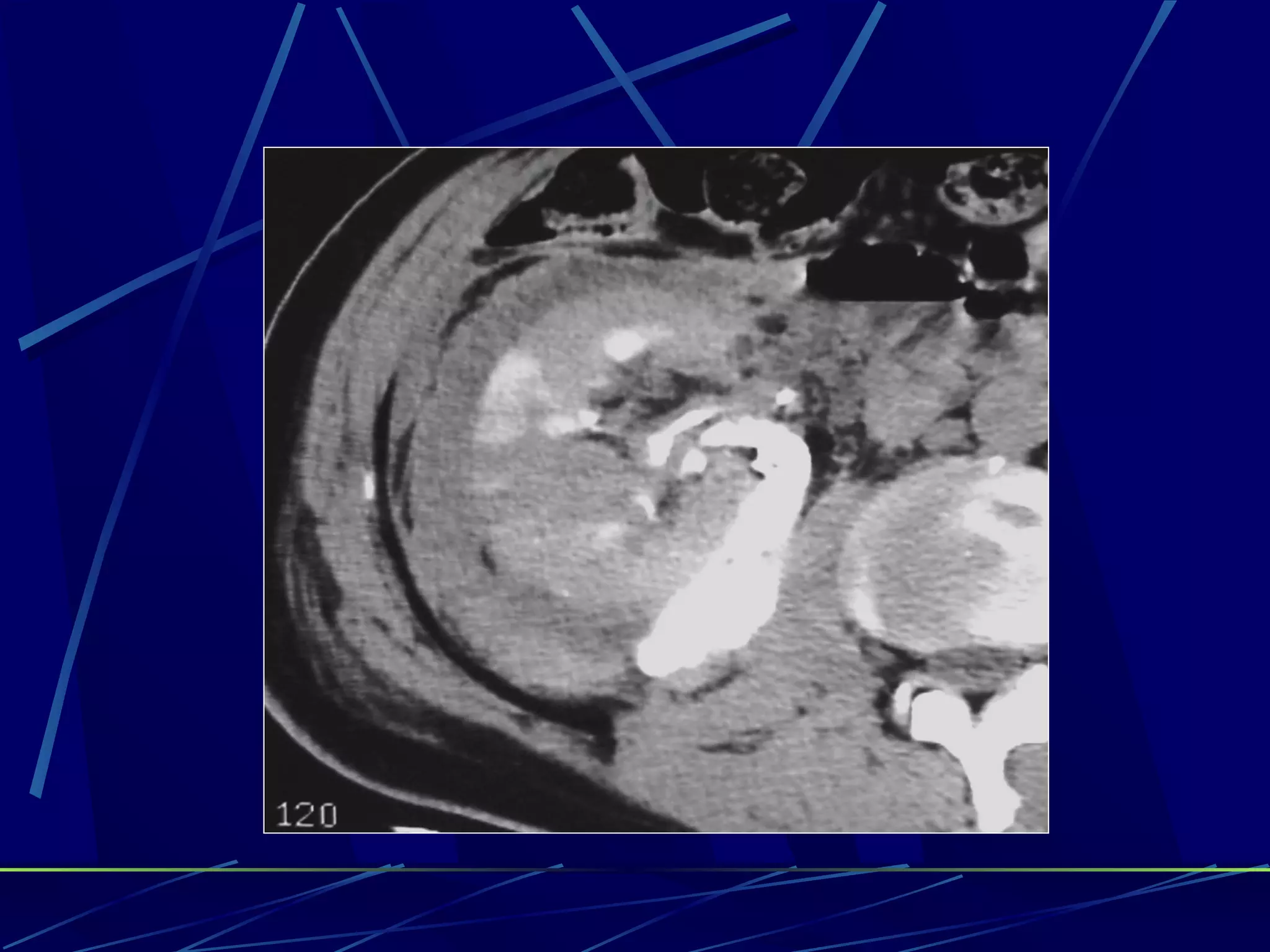 Chấn thương bụng kín | PPT