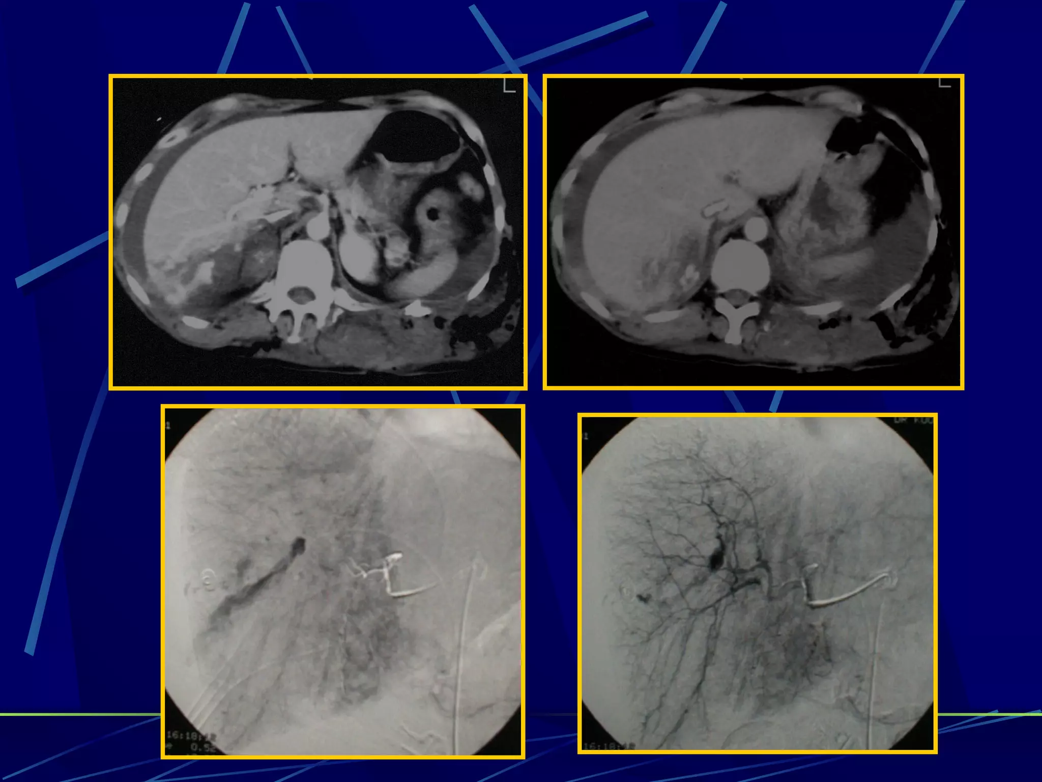 Chấn thương bụng kín | PPT