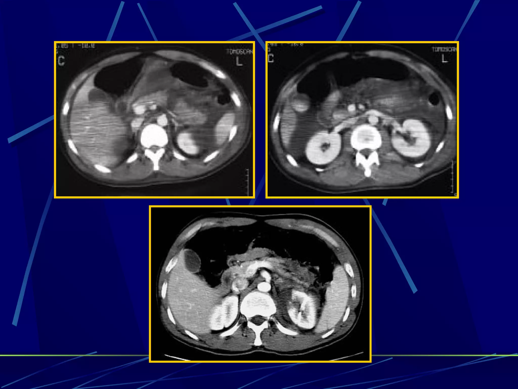 Chấn thương bụng kín | PPT