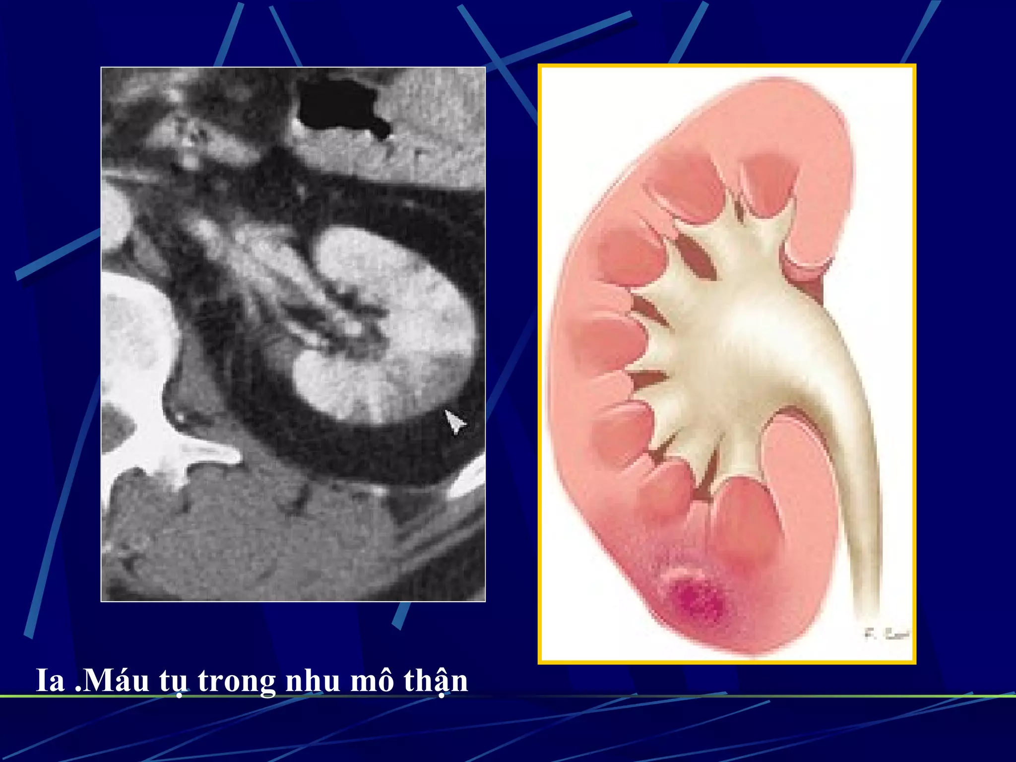 Chấn thương bụng kín | PPT