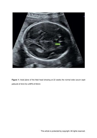 Chaoui 2016 csp 22q11 giãn khoang vách trong suốt | PDF